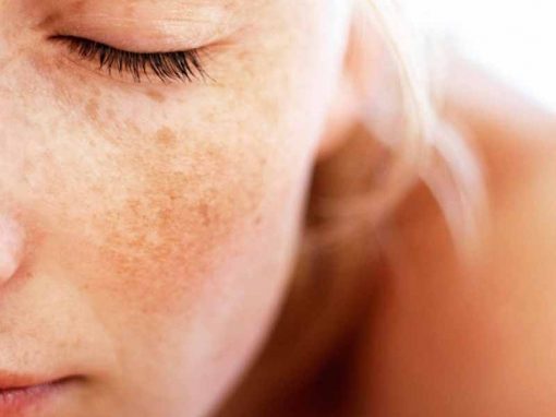 Melasma | Centro de especialistas de la piel